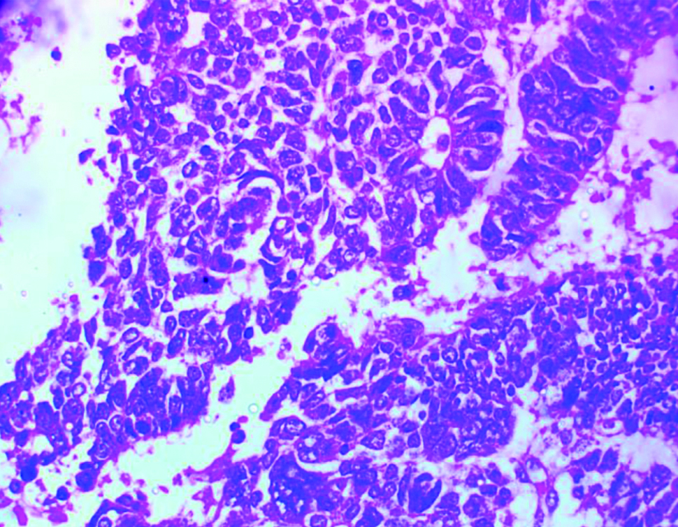 Photomicrograph of a nephroblastoma showing sheets of blastema cells ...