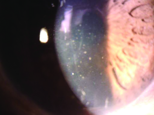 Showing presence of anterior chamber reaction, keratic precipitates and ...