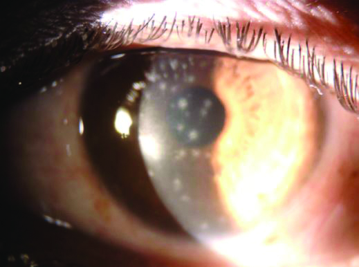 Subepithelial Infiltrates