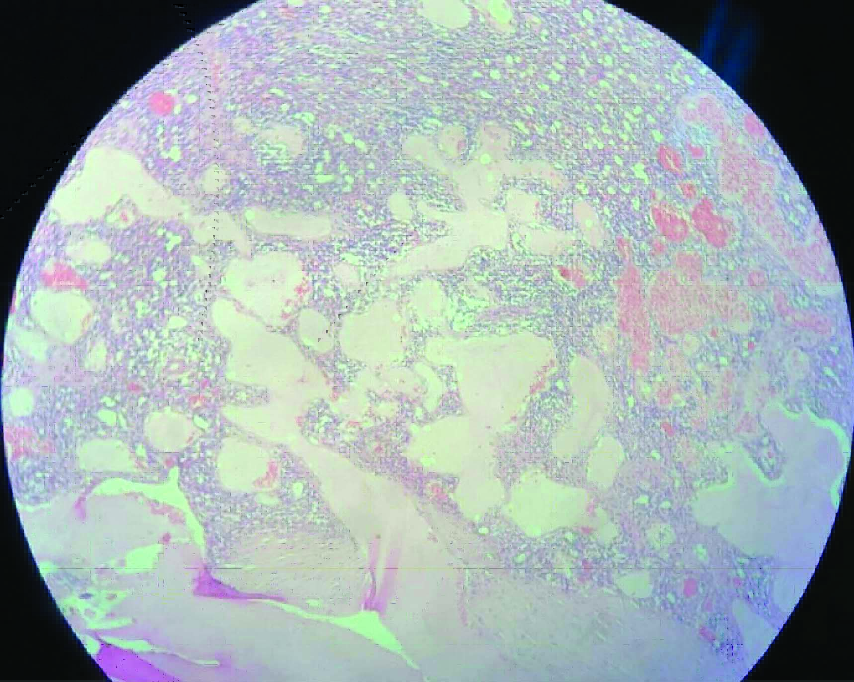 Photograph depicting variable dilated cystic spaces filled with both ...