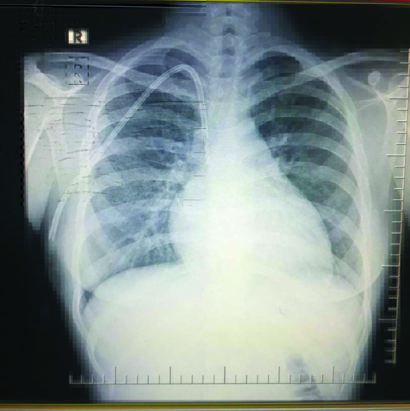 Chest X-ray depicting TCC and position of catheter tip at junction of ...