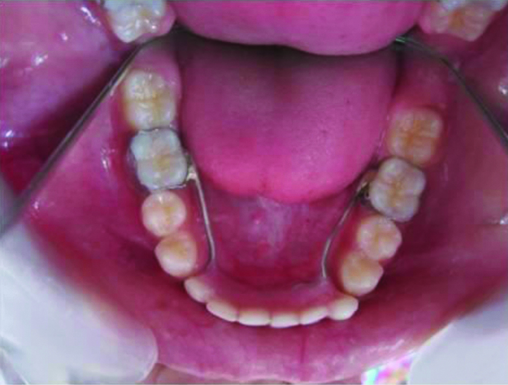Functional Space Maintainer in mandibular anterior region.