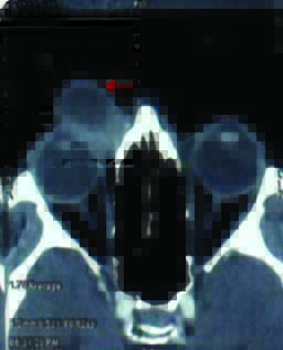 Image of CT scan of orbit showing a well-defined, cystic lesion in ...