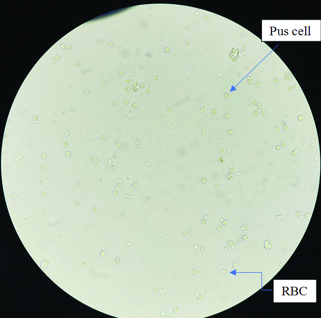 A photograph showing pus cells and red blood cells in urine wet mount ...