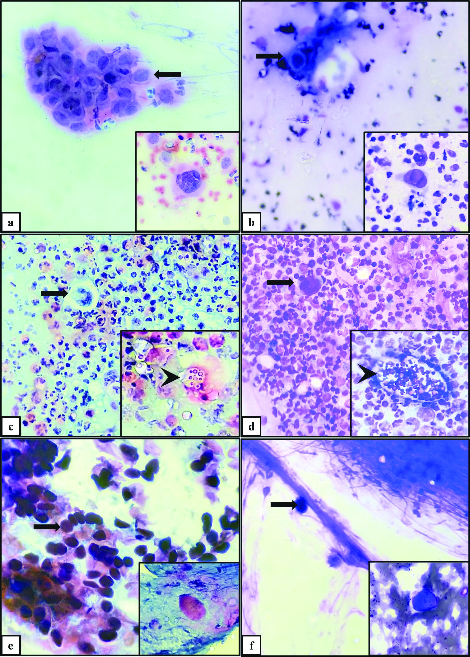 Acantholytic Cells