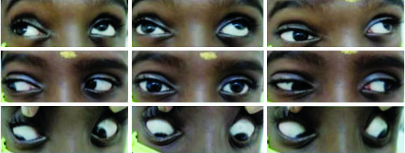 Photograph showing restricted extraocular movements.