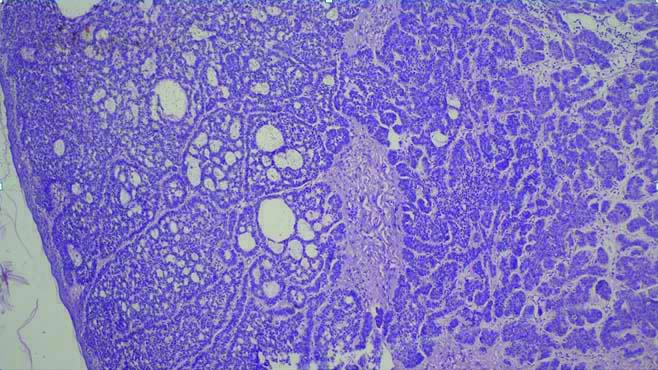 Microscopy of BCC with sebaceous differentiation (H&E, 100x).
