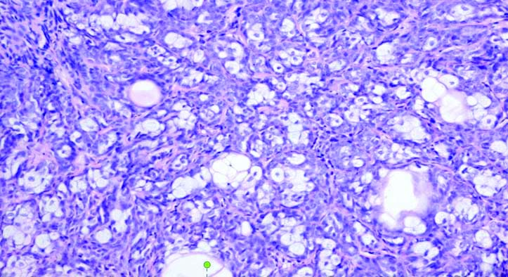 The tumour with mixed histology showed both classic nodular ...