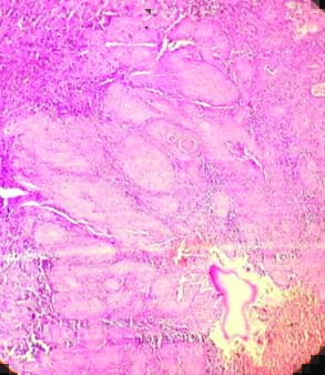 Photomicrograph (10X, H&E stained) showing invasion of proliferating ...