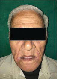 Case 2: Intraoral view of maxilla (Flabby ridge portion marked by ...