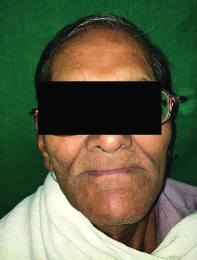 Case 3: Intraoral view of maxilla (flabby ridge portion marked by ...