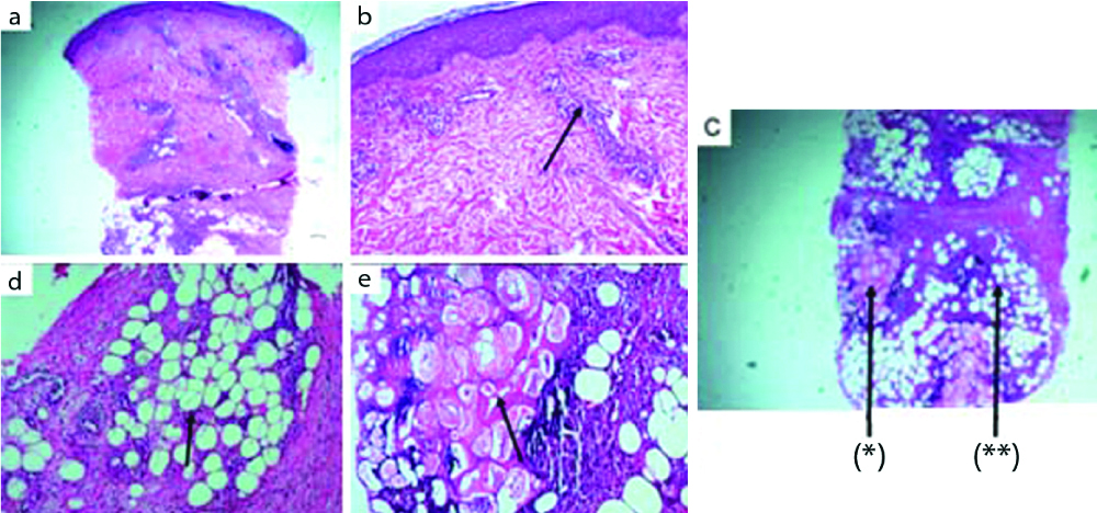 Fat Necrosis Pancreas