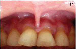 Incision given through the frenum