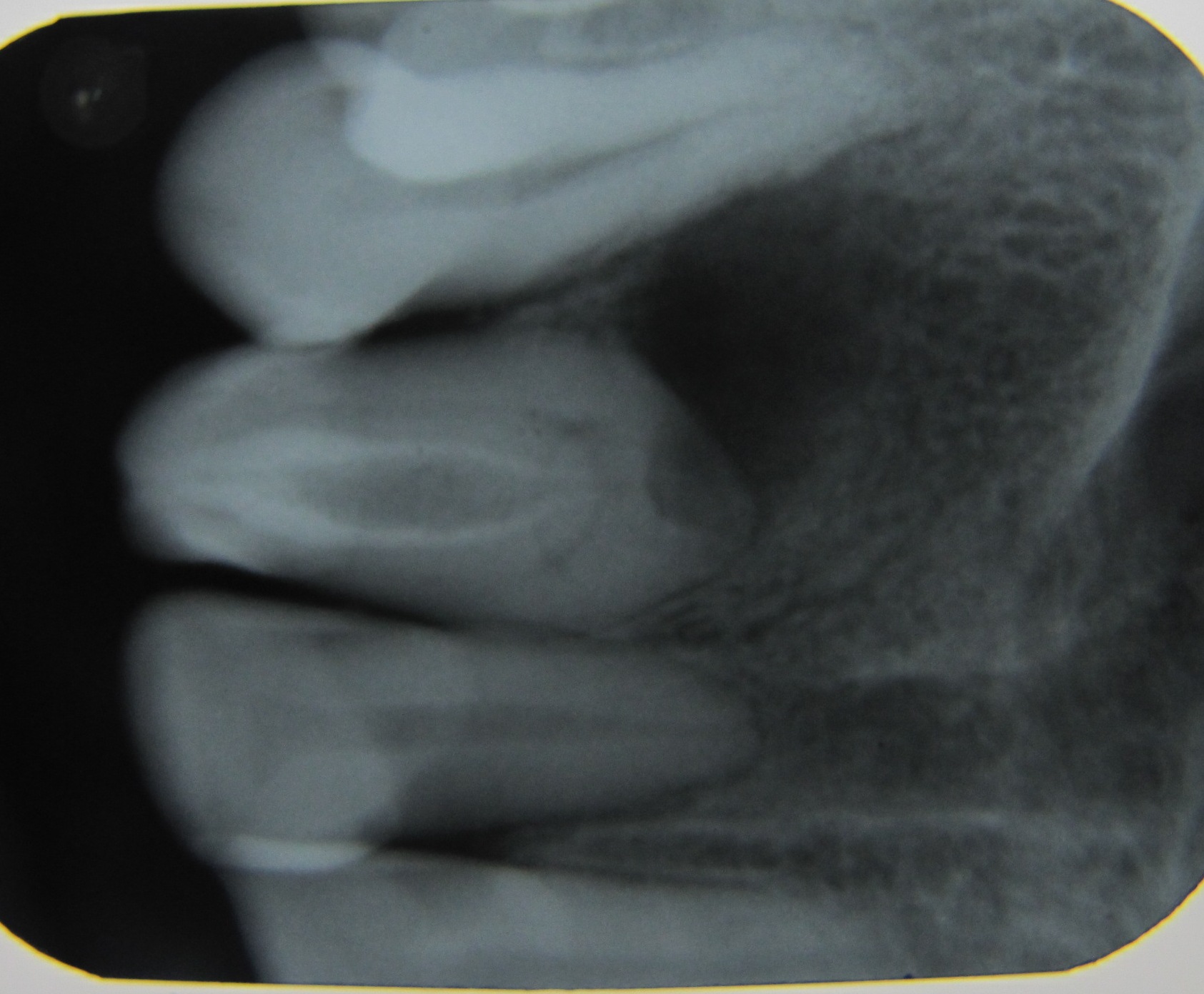 Dens In Dente Lateral Incisor