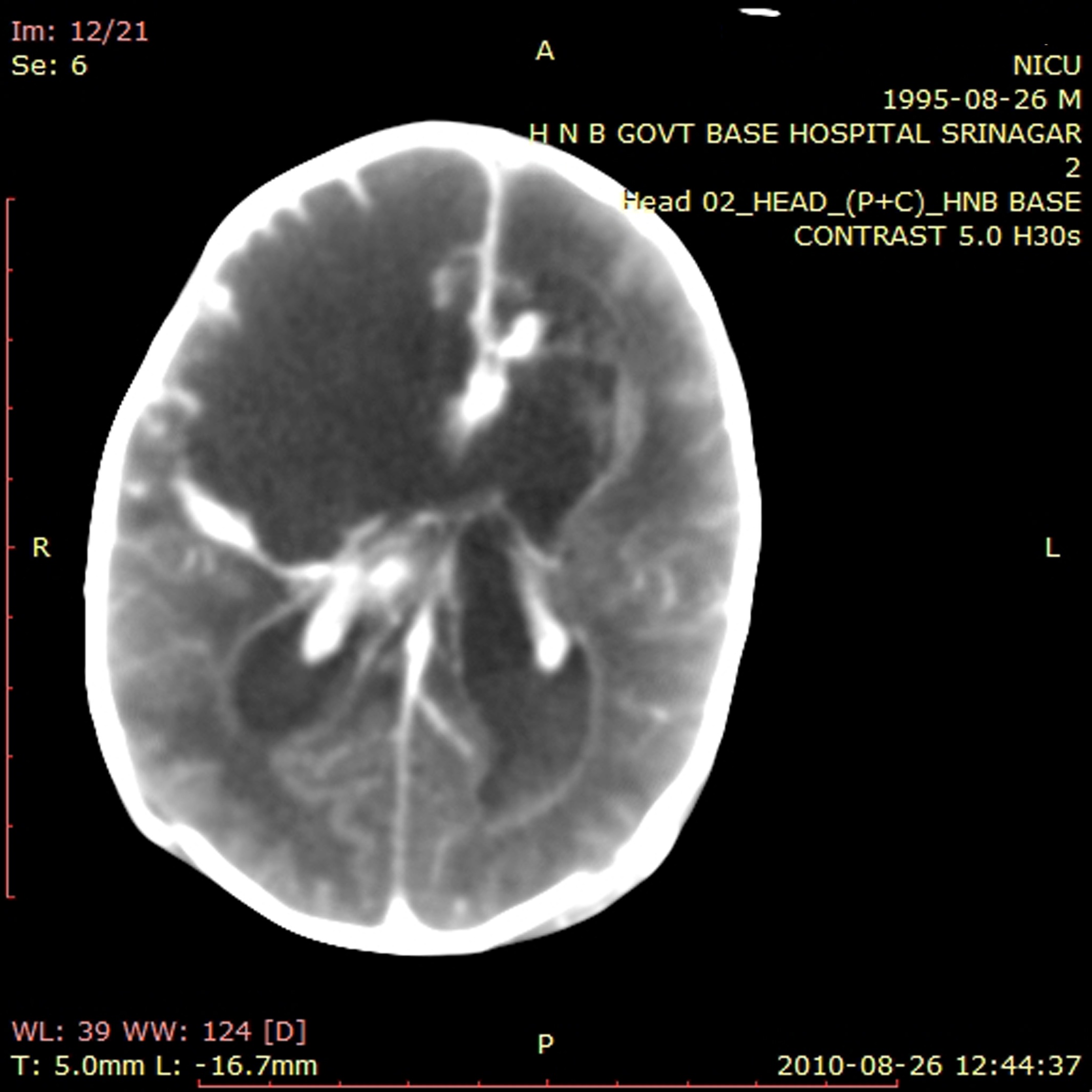 Image showing a large hypodense parenchymal lesion in the right frontal ...