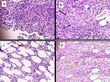 Idiopathic Thrombocytopenic Purpura Bone Marrow Findings
