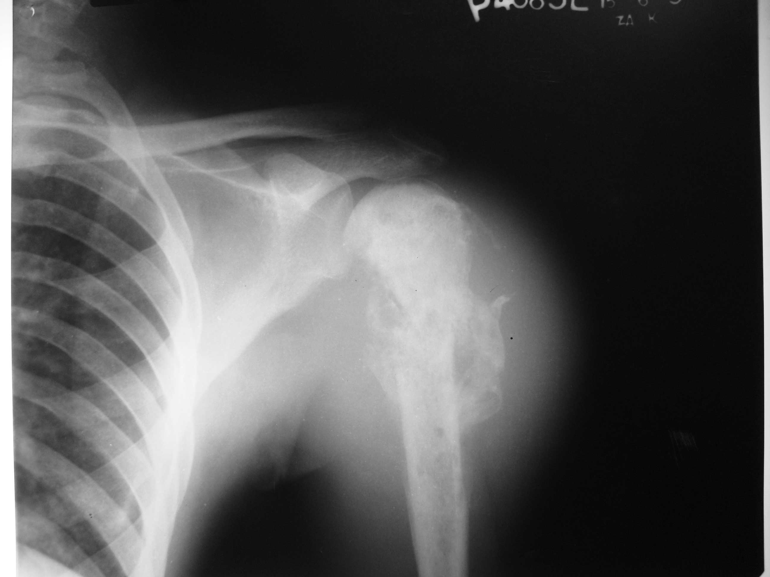 Reticulum Cell Sarcoma X Ray