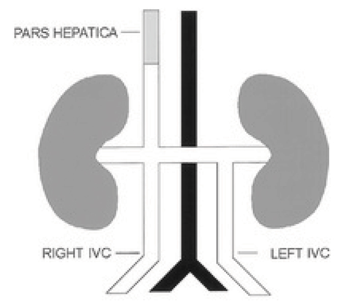 Diagram showing duplicated IVC