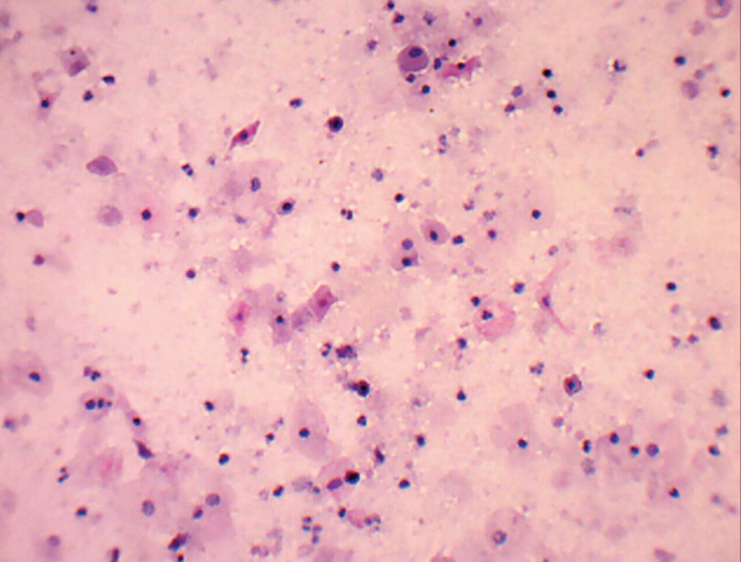 Epidermal Inclusion Cyst Cytology