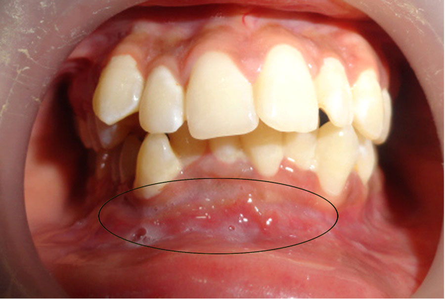 Central Giant Cell Granuloma Radiographic Features