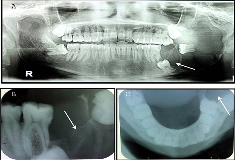 Adenomatoid Odontogenic Tumor Radiography