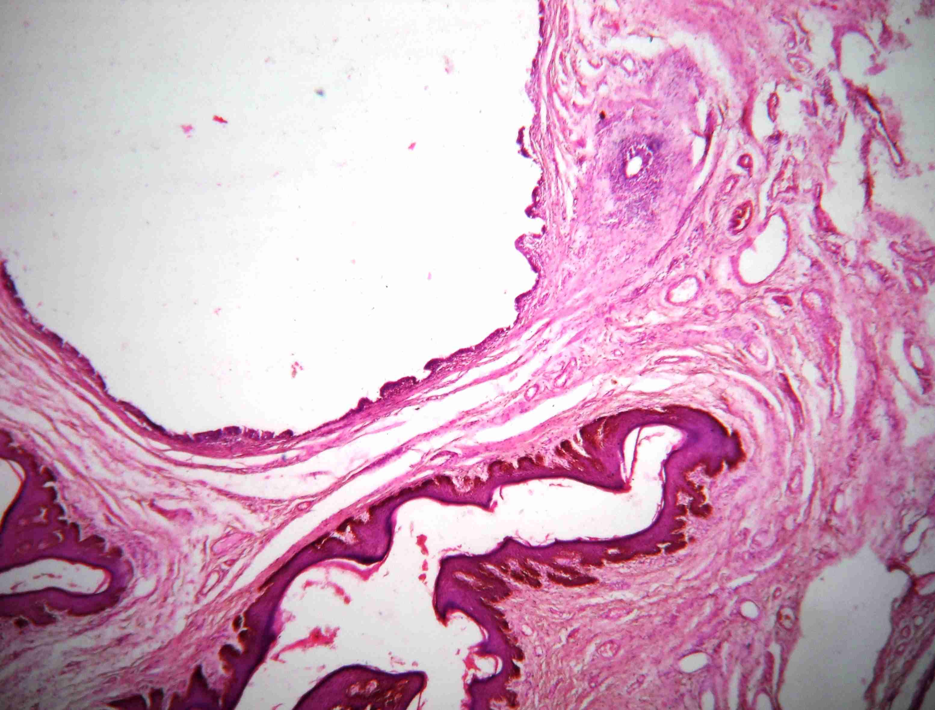 Pilonidal Cyst Histology