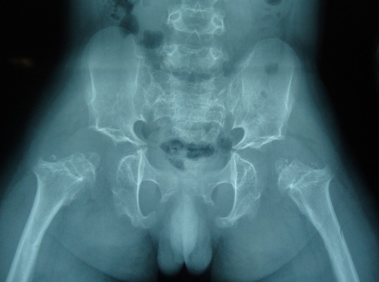 Xray Of The Pelvis Purpose Procedure And Risks