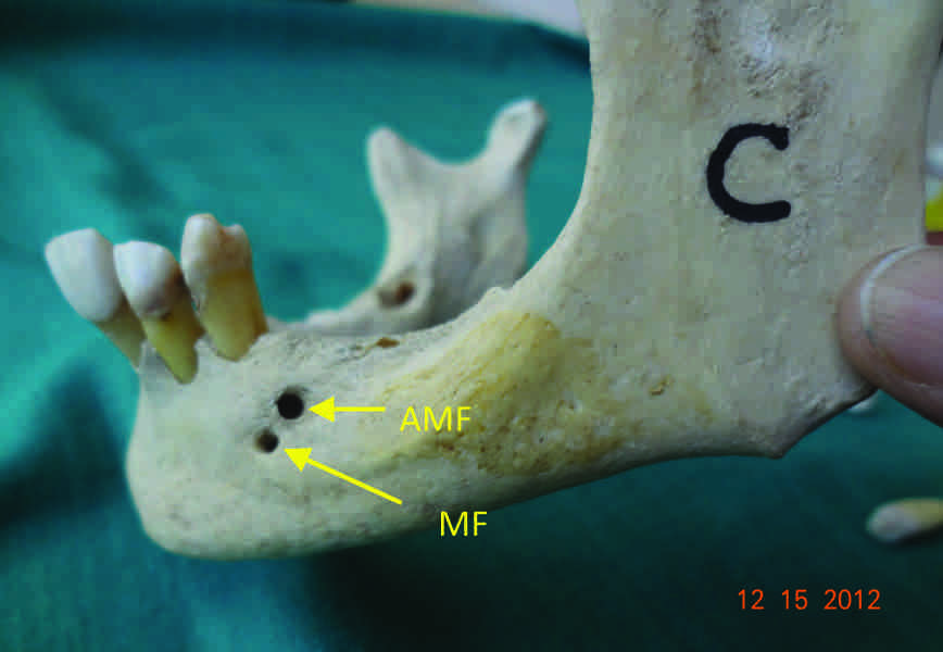 Mental Foramen Of Mandible