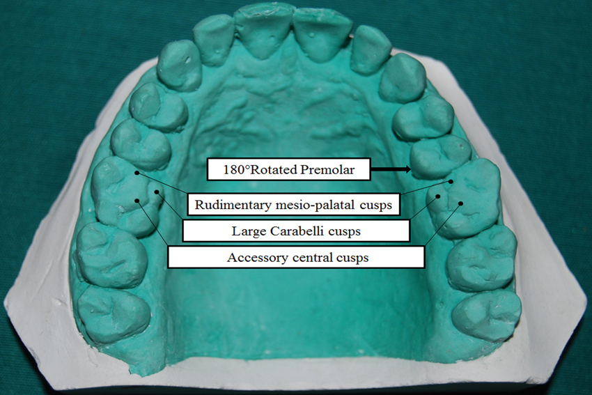 Occlusal view of the subject’s dental cast showing 180° rotated ...
