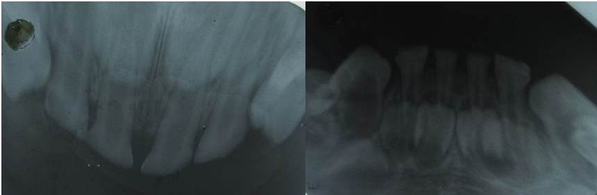 Hereditary Brown Opalescent Dentin Radiograph