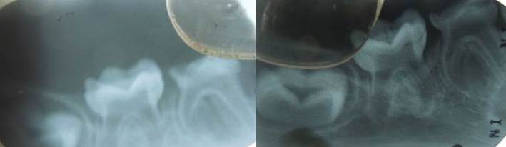 Hereditary Brown Opalescent Dentin Radiograph
