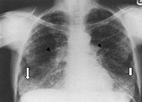 Chest X-Ray showing prominent broncho-vascular markings (black arrows ...