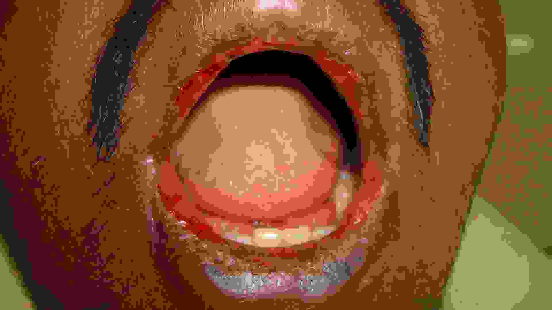 Erythema Multiforme Oral