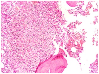 Urticaria Pigmentosa Histology