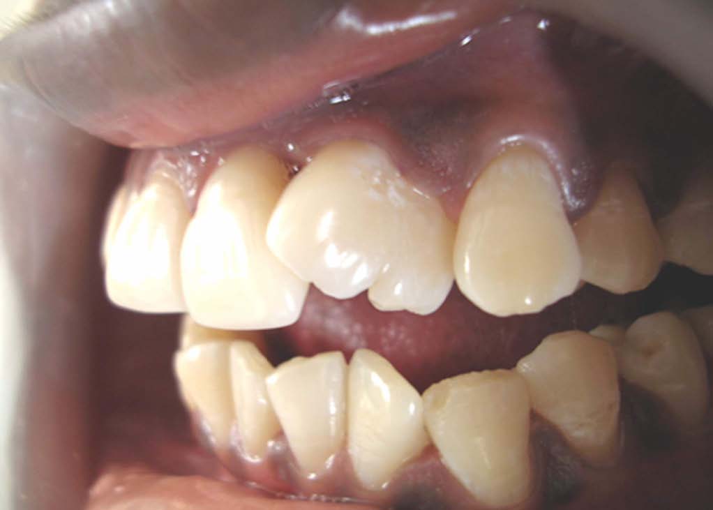 Twining Teeth