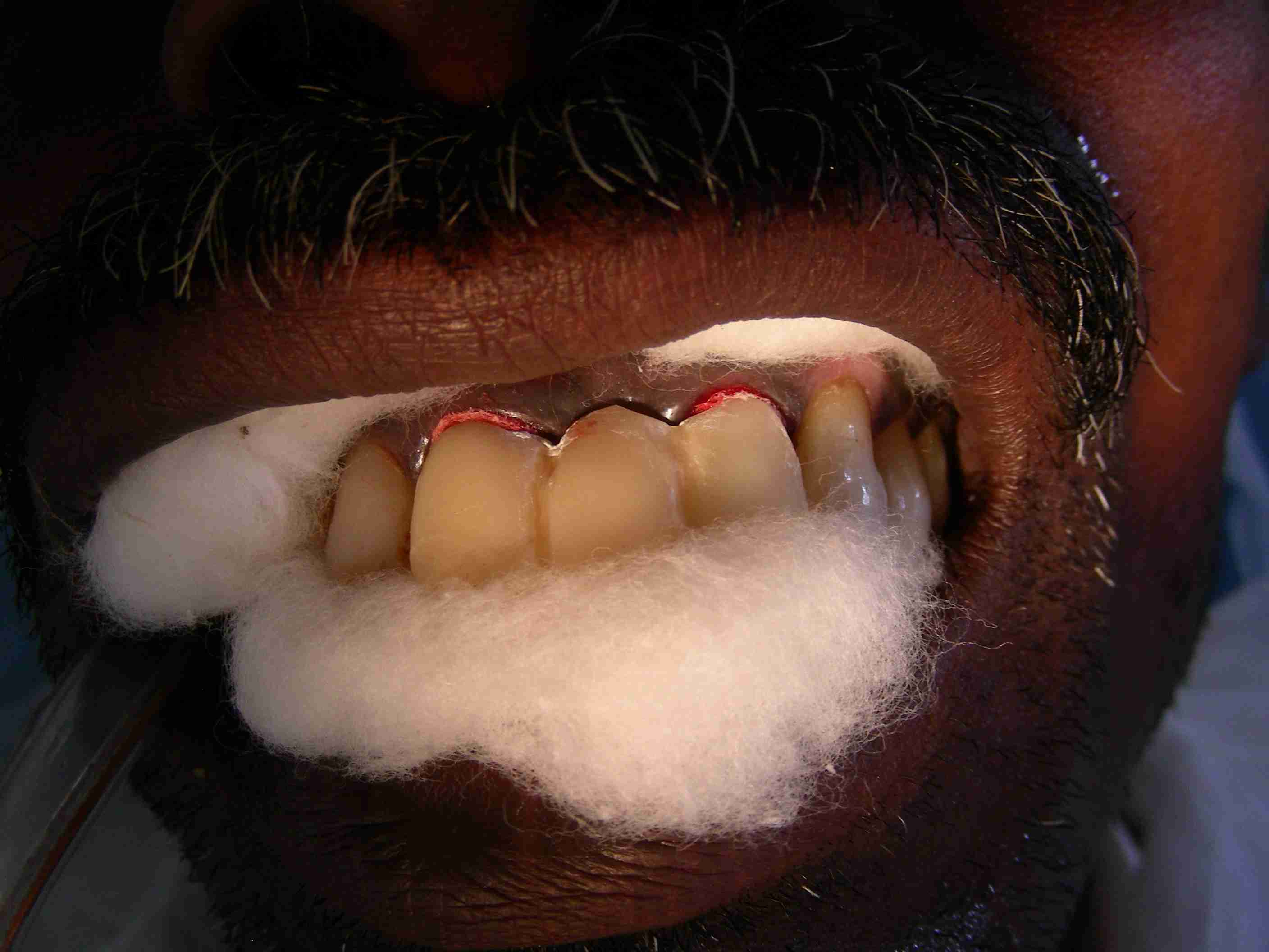 After retraction with Merocel strip