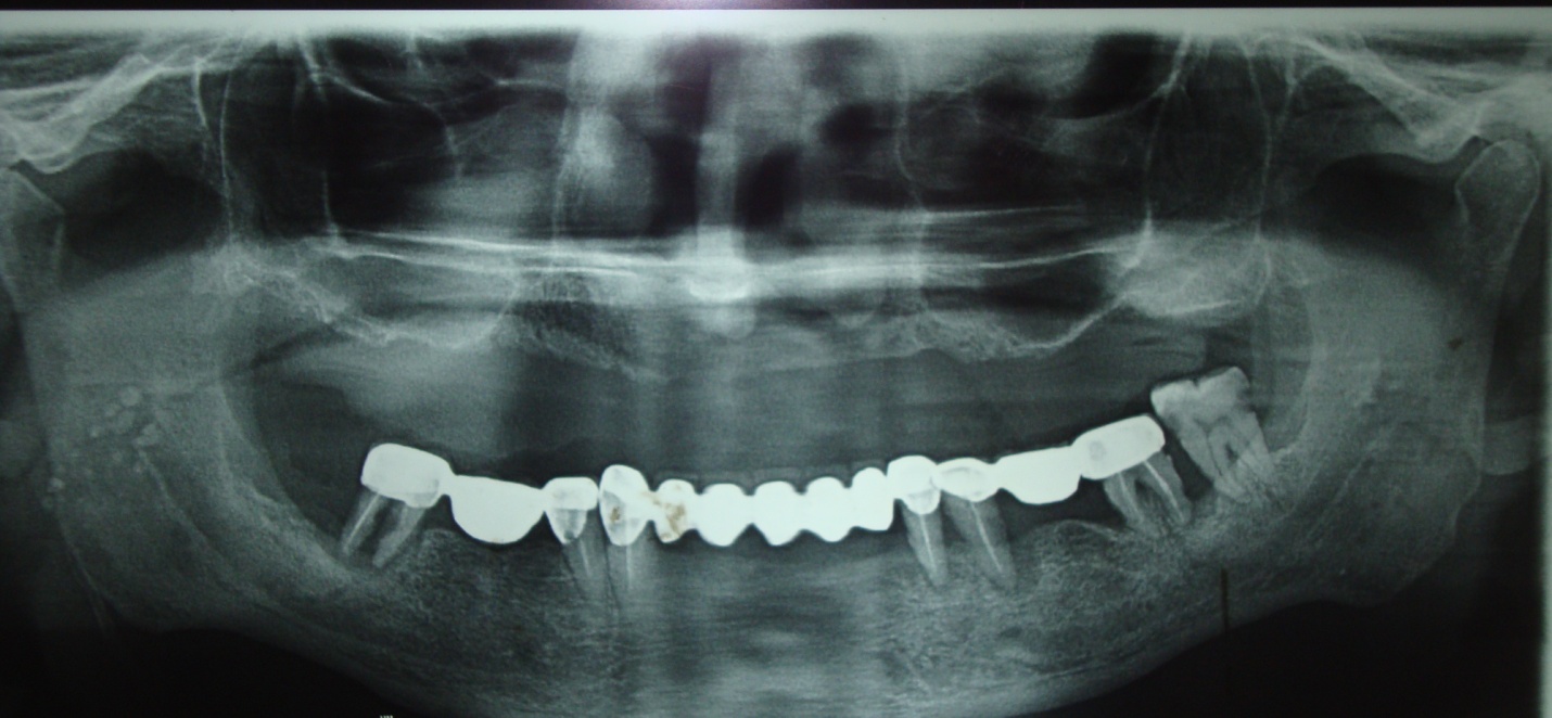 Tonsilloliths Radiograph