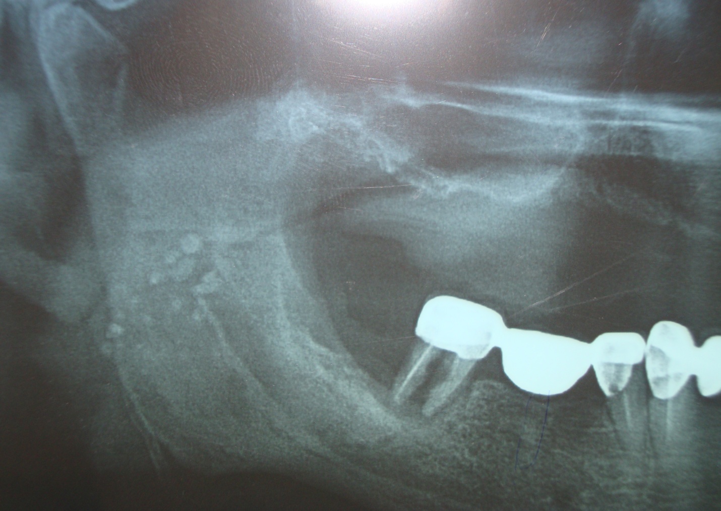 Tonsilloliths Radiograph