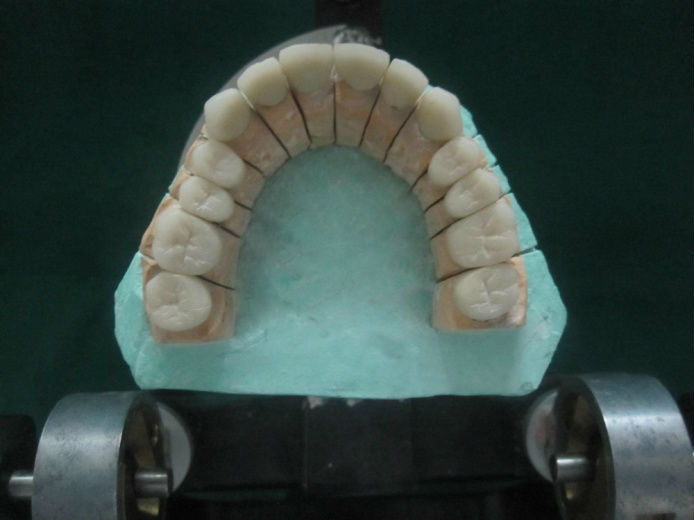 Mandibular cast showing Die sectioning with individual PFM Crowns