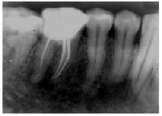 Periapical Abscess Radiograph