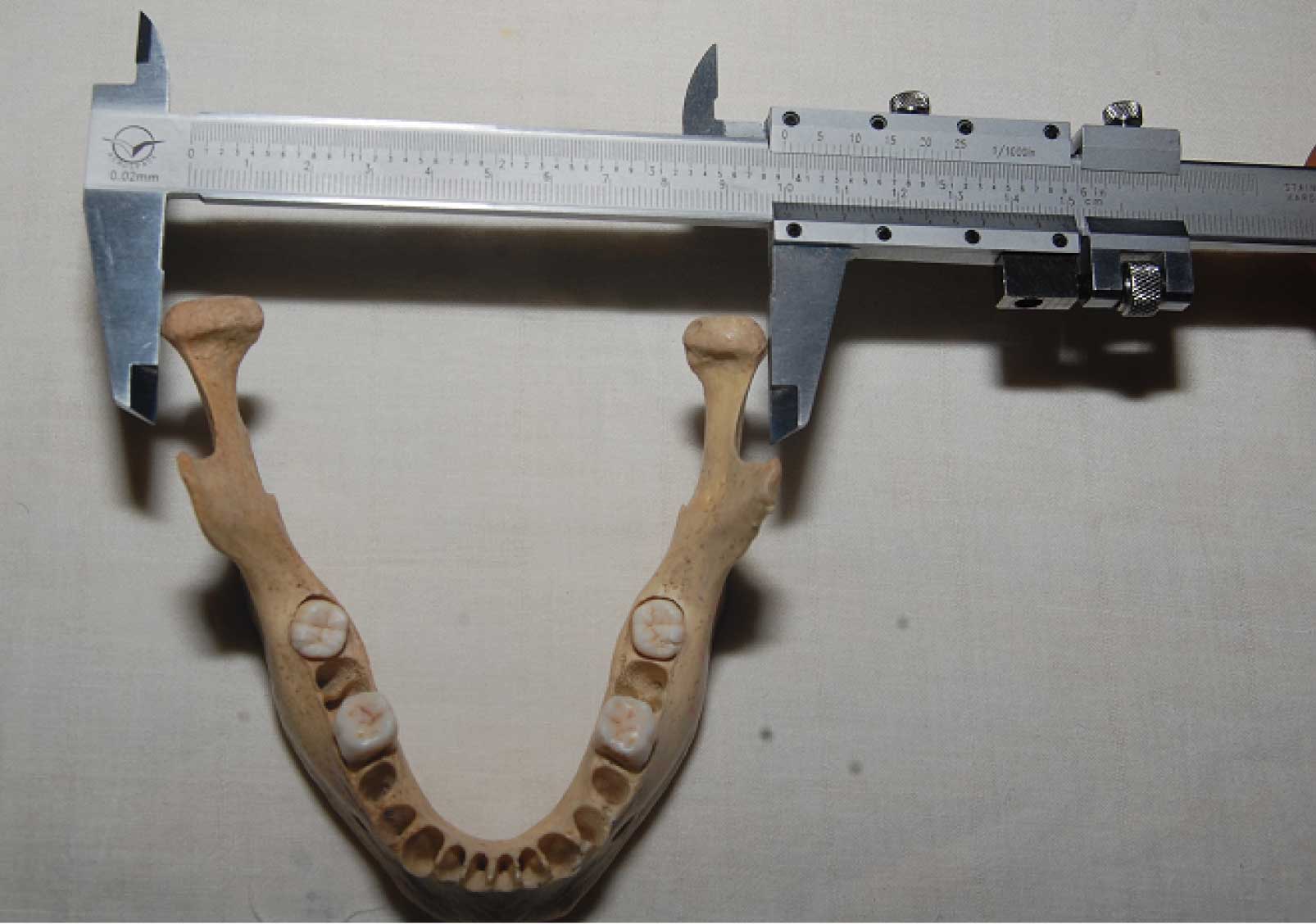 Mandibular length is the distance of anterior margin of the chin from a ...
