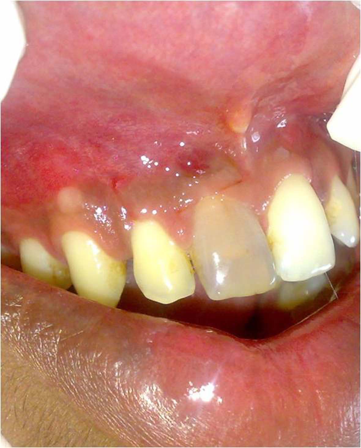 Periapical abscess