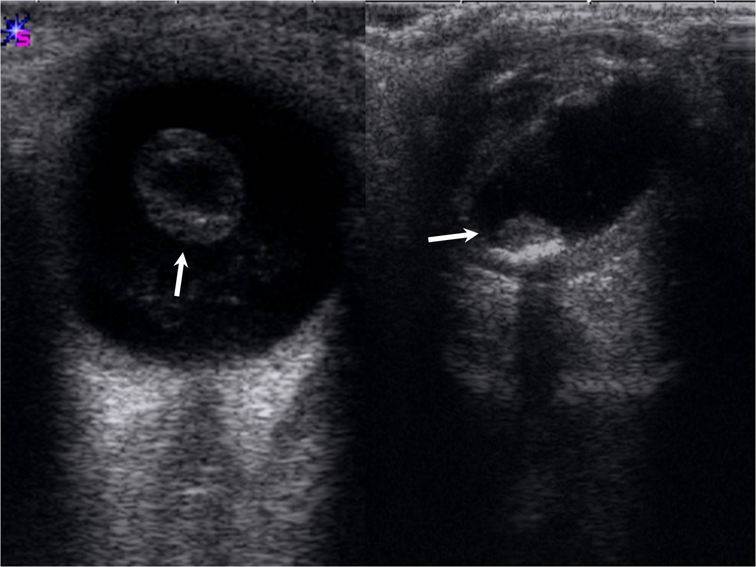 B Scan showing Post traumatic dislocated Cataractous Lens