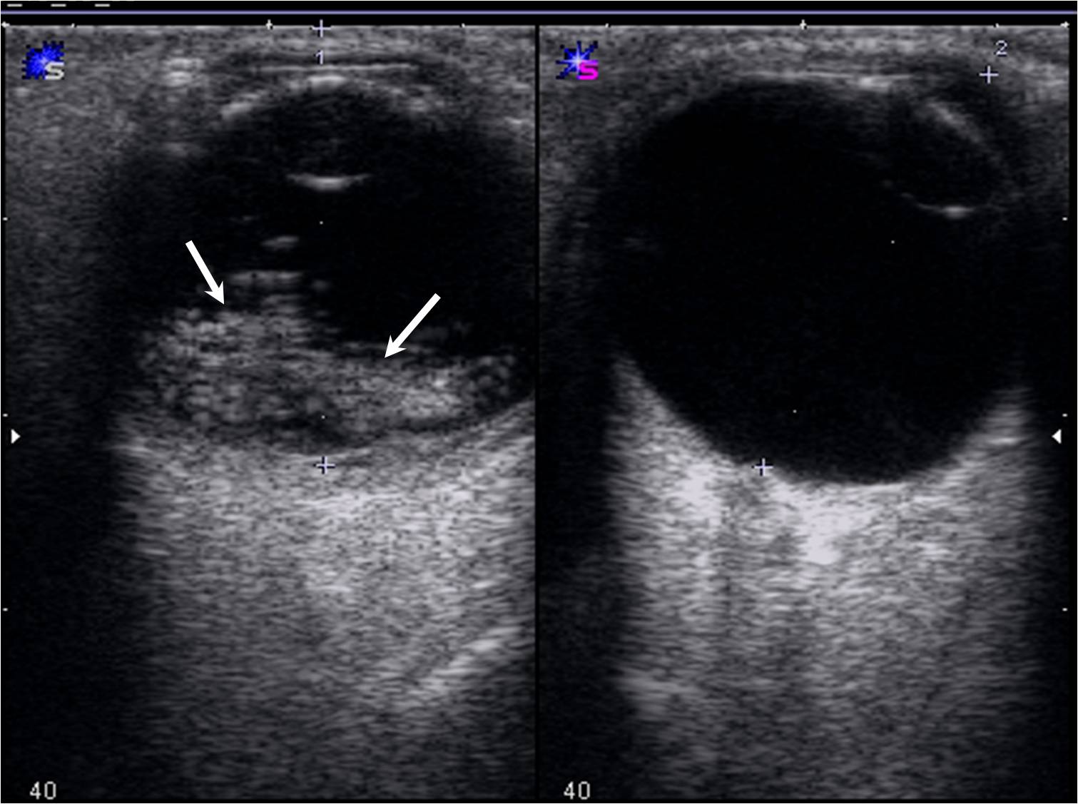 Asteroid Hyalosis On B Scan