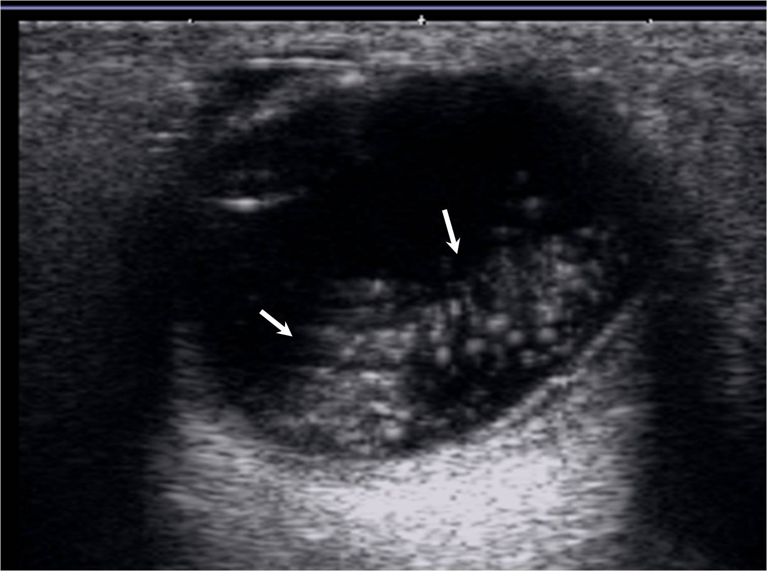 Asteroid Hyalosis On B Scan