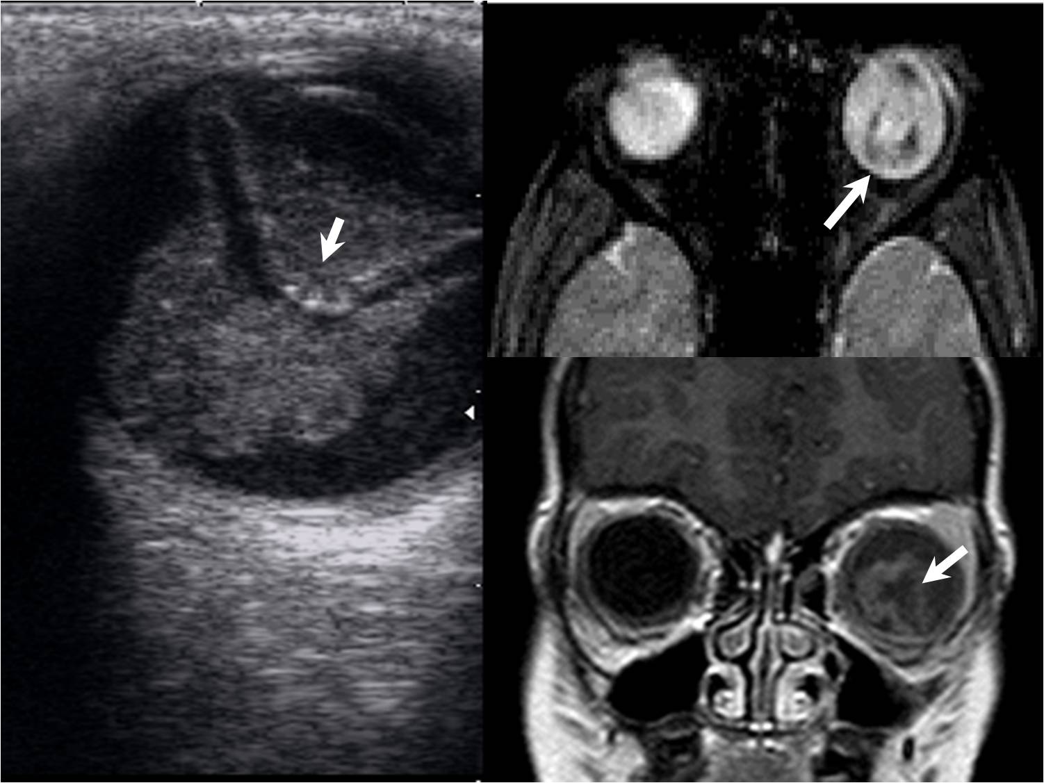 USG and MRI showing calcifications in Retinoblastoma