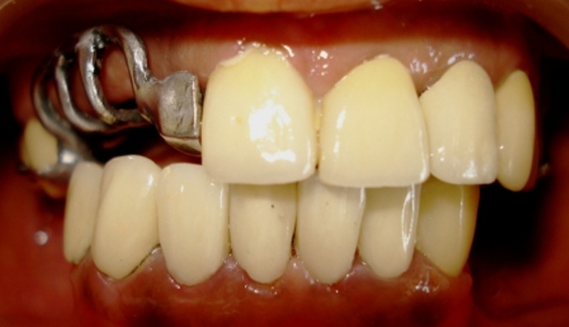 Semi Precision Attachment Abutment