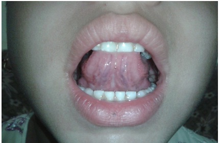 Mucocele Under Tongue