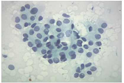 Cells in syncytial clusters. (H&E stain, x400)
