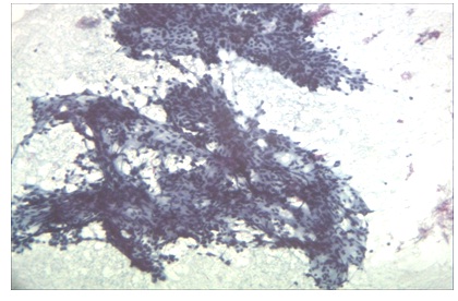 Cells in monolayered sheets. (H&E stain, x100)